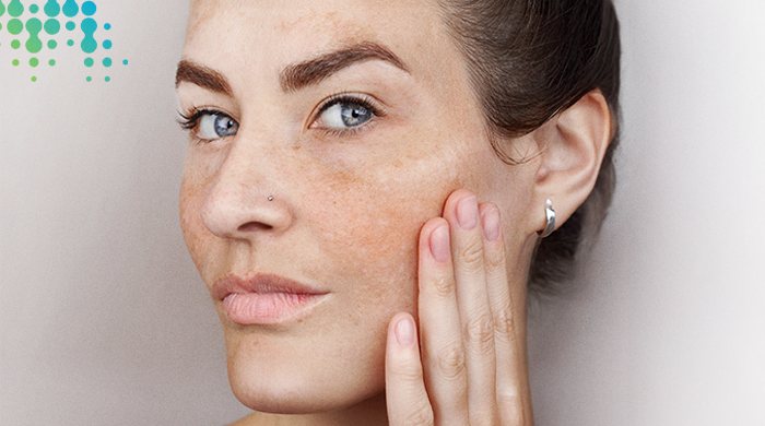 Manchas na pele? Pode ser melasma! Descubra como evitar e tratar ...